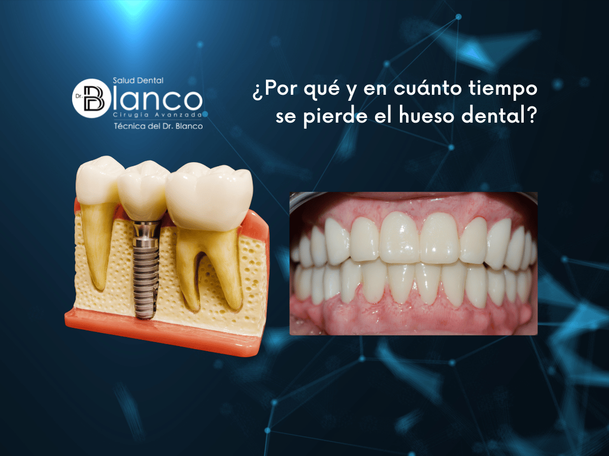Pérdida de hueso dental: ¿Por qué y en cuánto tiempo se pierde?